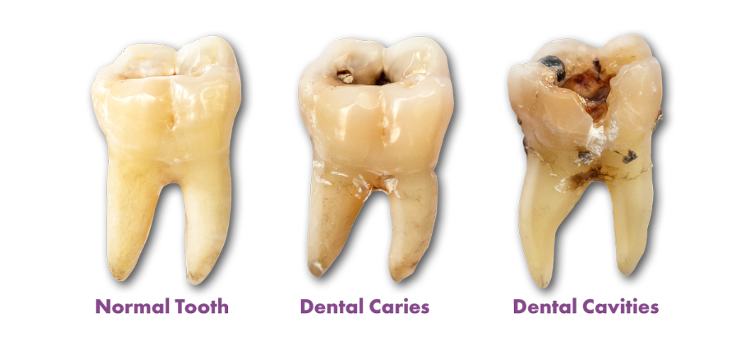 Everything you need to know about tooth decay and cavities! - Dental ...